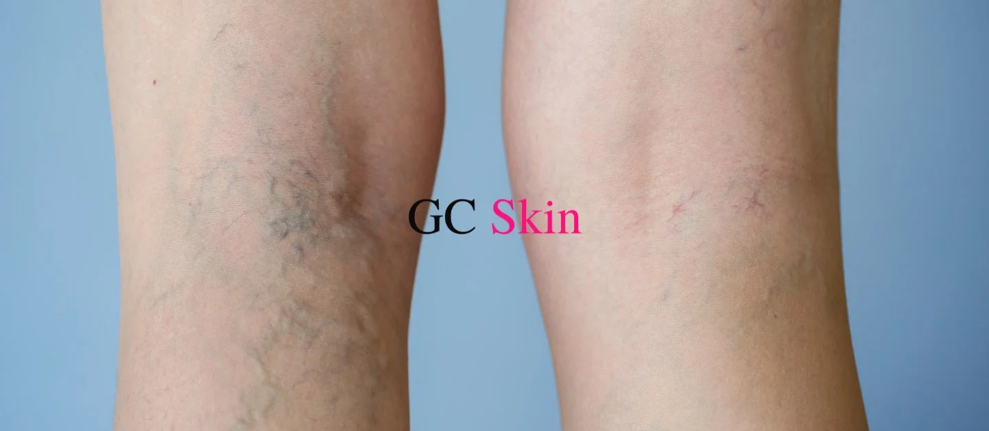 ¿Qué son las varices? - GC Skin Medspa
